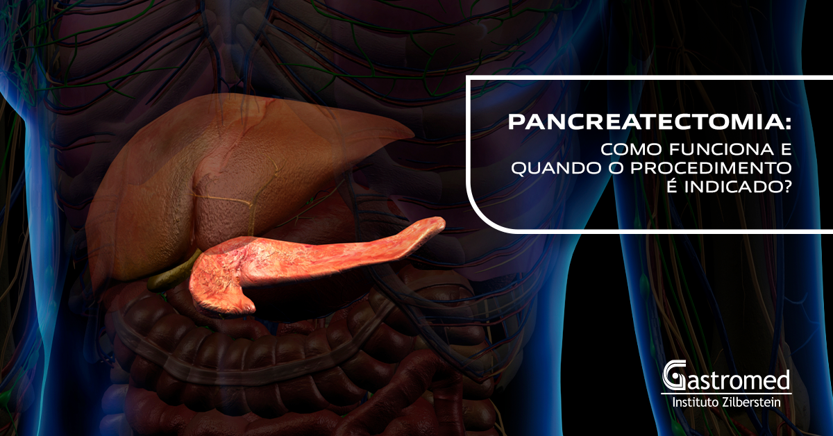 Pancreatectomia: como funciona e quando o procedimento é indicado ...